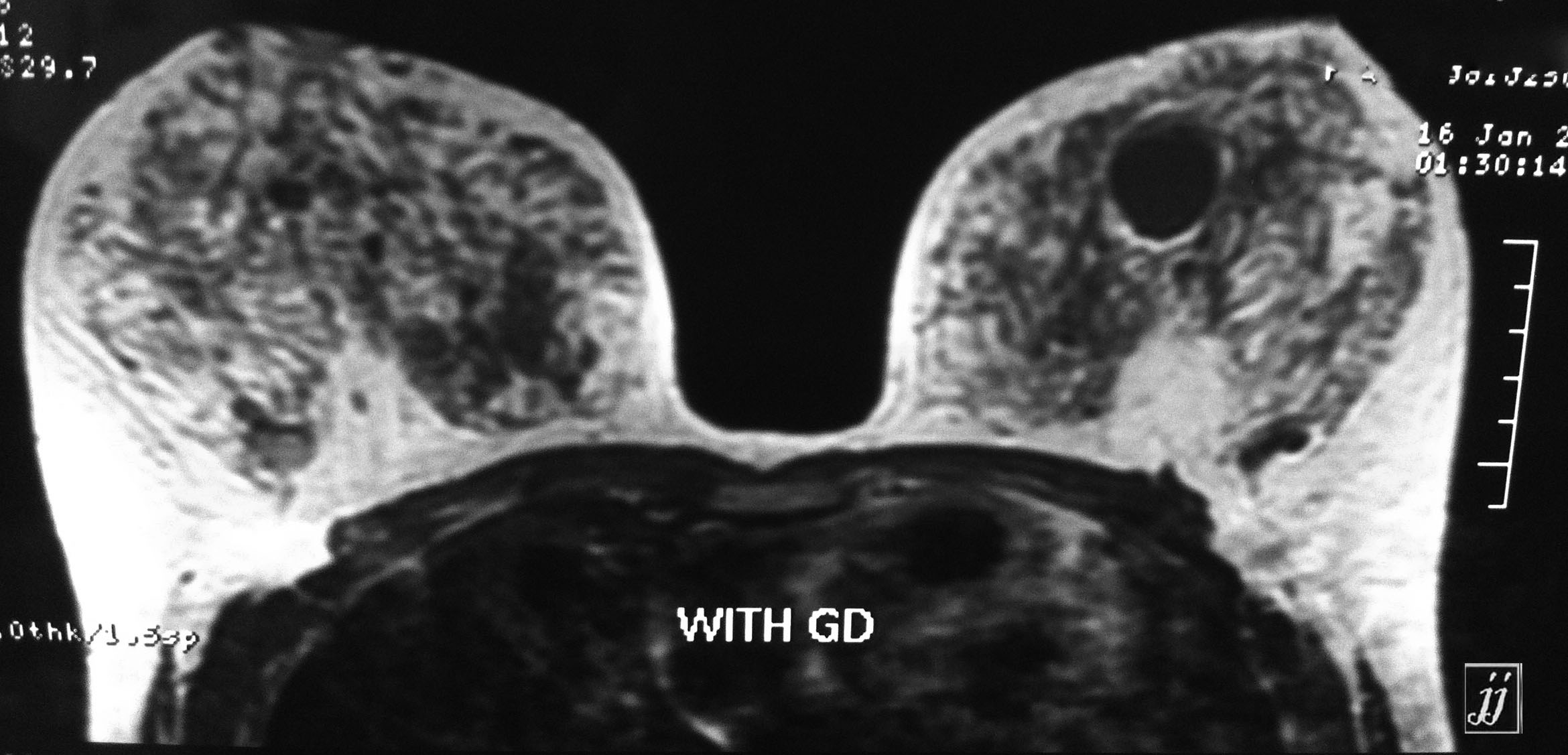Breast- left breast cyst with fluid fluid level (5) - Radioogle