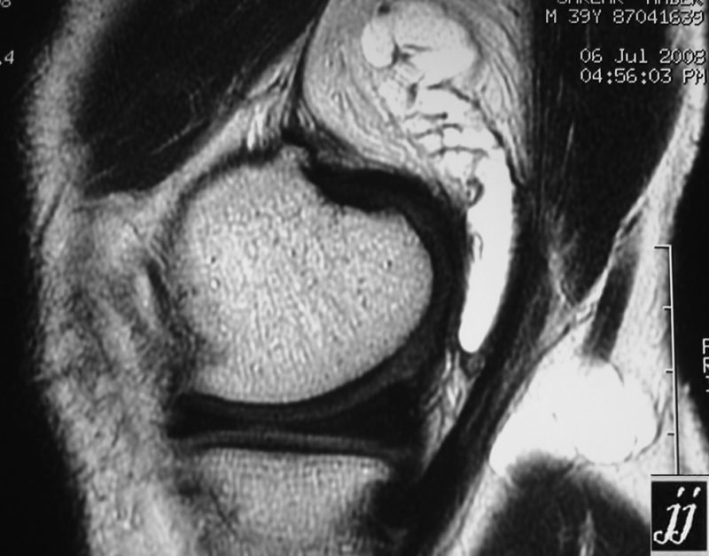 MSK- multi septate popliteal cyst (4) - Radioogle