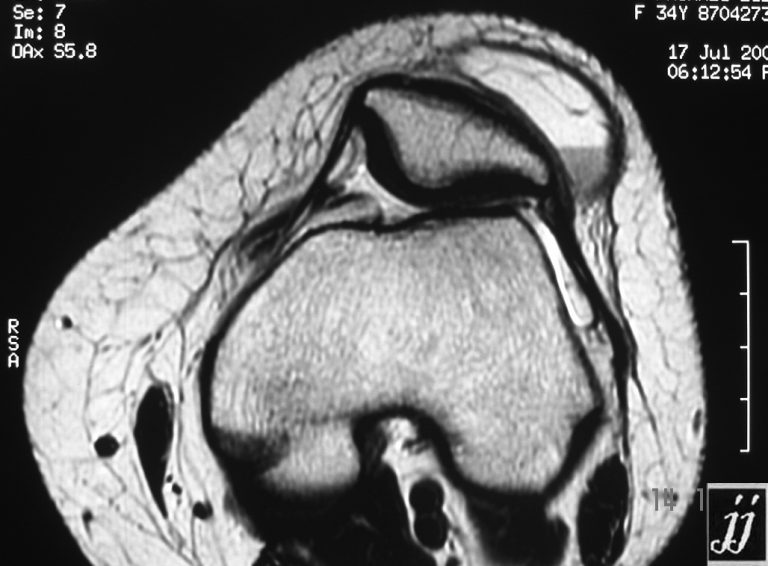 MSK- pre patellar cellulitis or bursitis and popliteal cyst with fluid ...