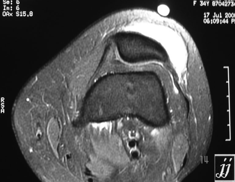 MSK- pre patellar cellulitis or bursitis and popliteal cyst with fluid ...