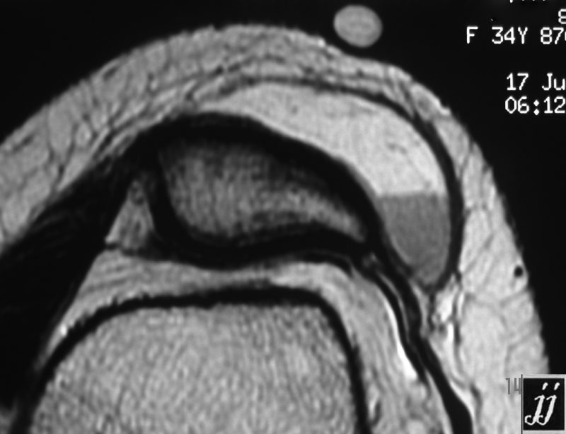 MSK- pre patellar cellulitis or bursitis and popliteal cyst with fluid ...