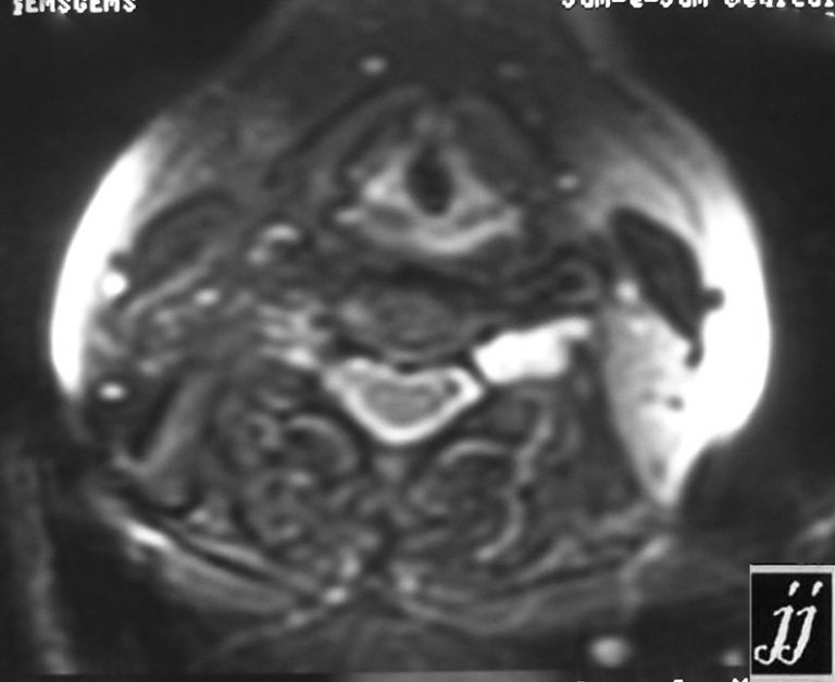 Spine- left cervico dorsal junction lateral perineural cyst (5) - Radioogle