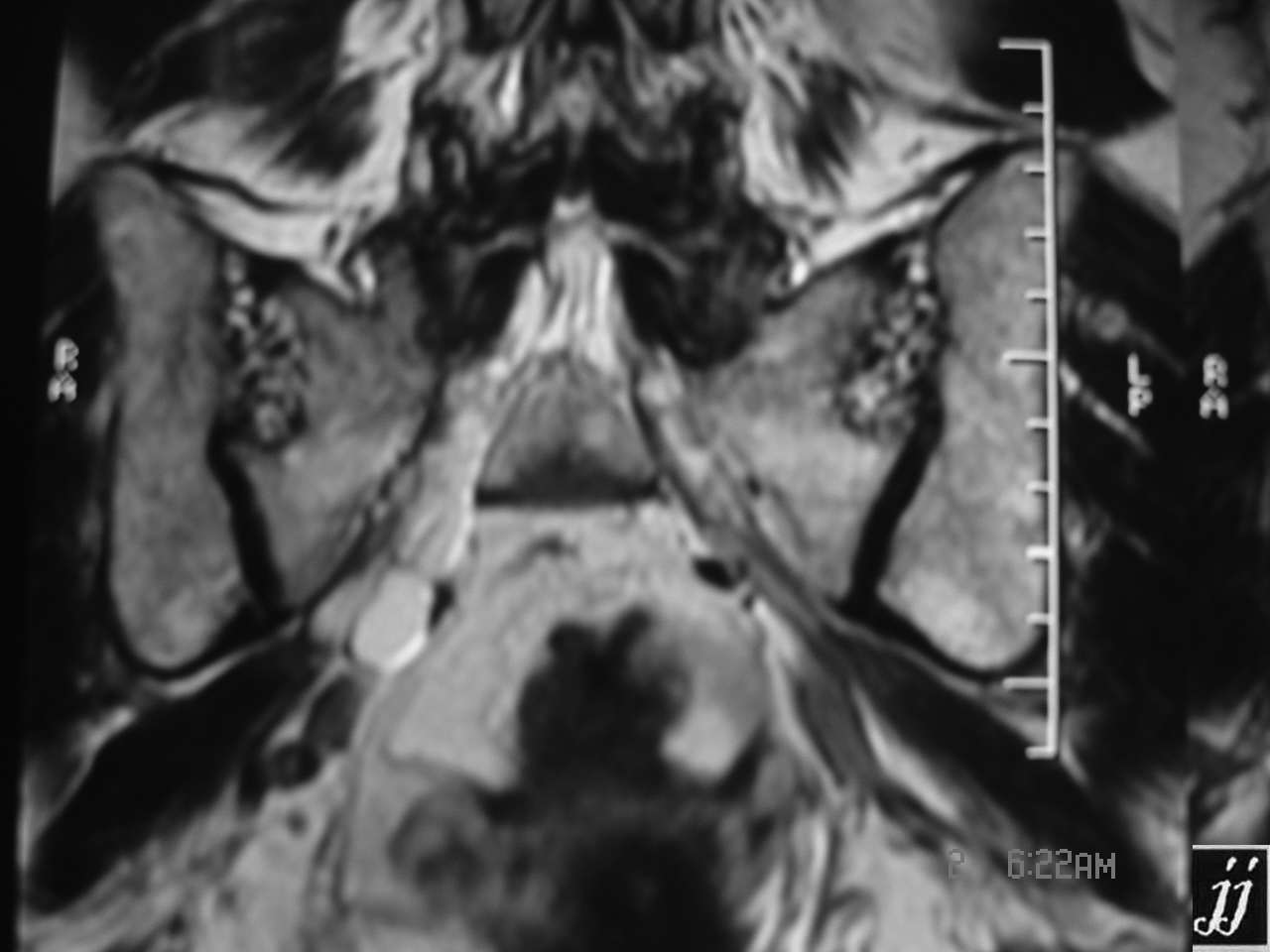 Abdomen- para spinal muscle atrophy, multiple perineural cyst of sacrum ...