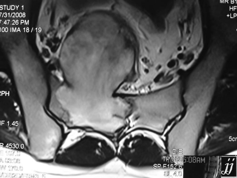 Abdomen- right pelvic sacral tumor, chordoma chondroma (11) - Radioogle