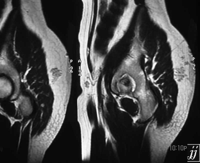 Abdomen- subcutaneous cellulitis over gluteal region (3) - Radioogle