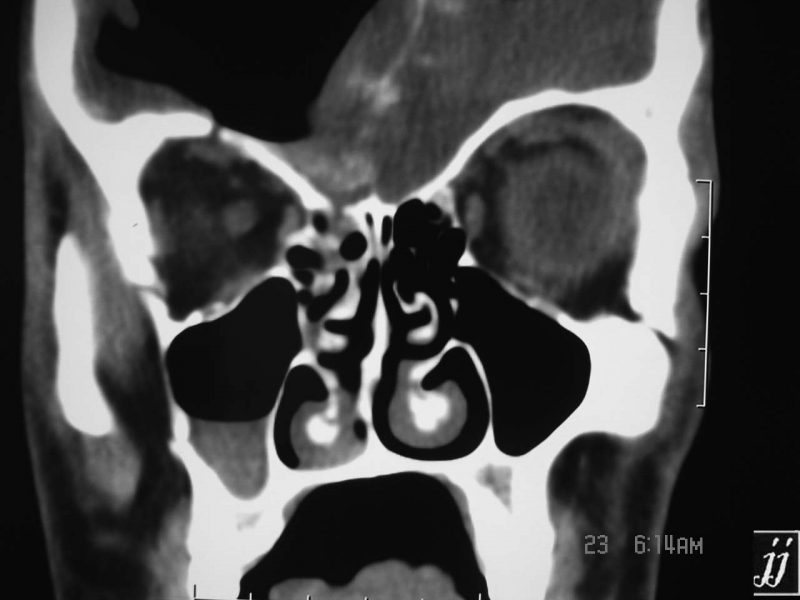 ENT- frontal and nasal orbital fractures with air acephalous and skull ...