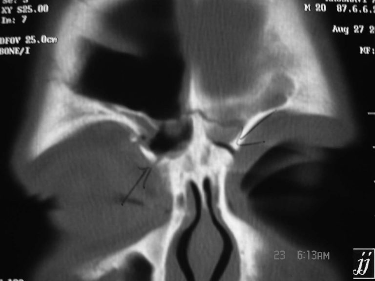 ENT- frontal and nasal orbital fractures with air acephalous and skull ...