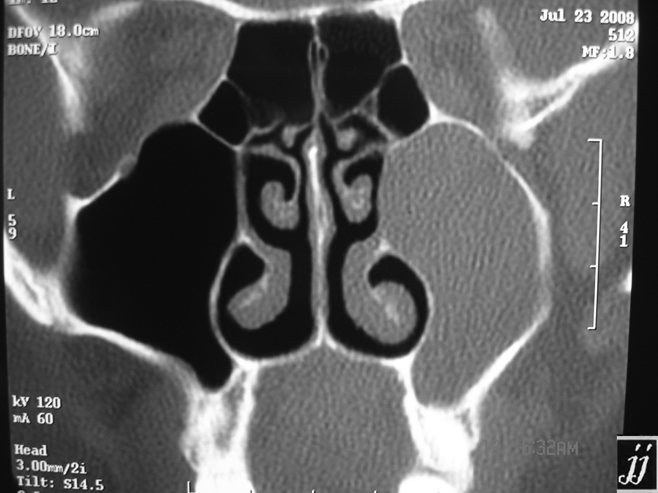 ENT Maxillary Sinus Retention Cyst Radioogle
