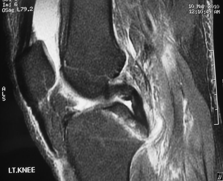 MSK- detached fracture posterior tibial bone (5) - Radioogle