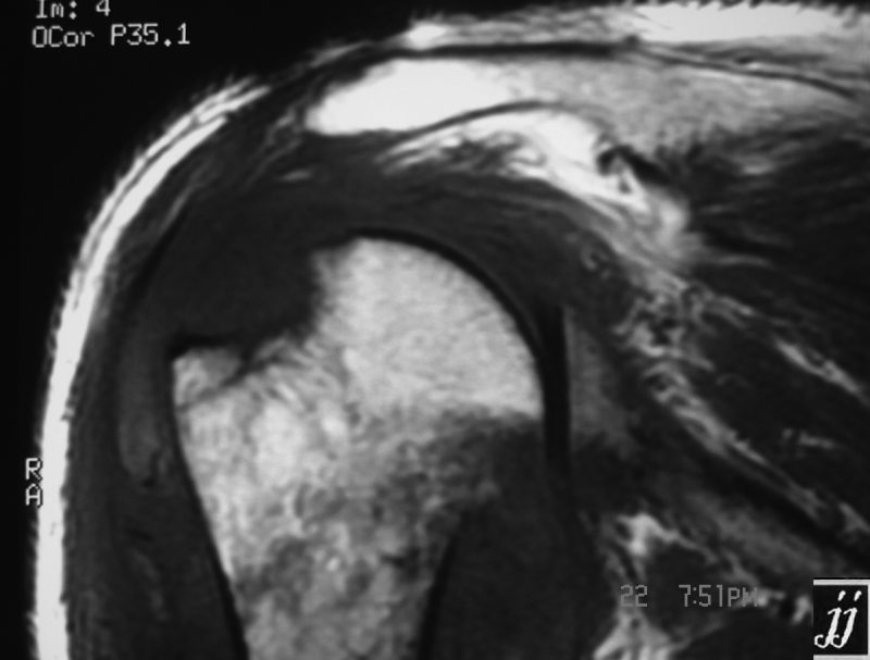 MSK- humeral greater tuberosity erosion defect adjacent tumefaction and ...