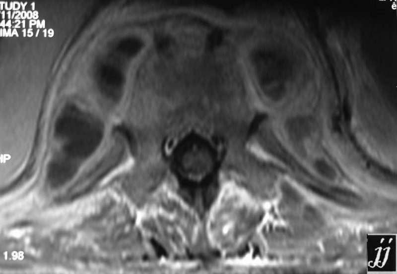 Spine- psoas muscle abscess (tuberculosis) and fused vertebra (8 ...