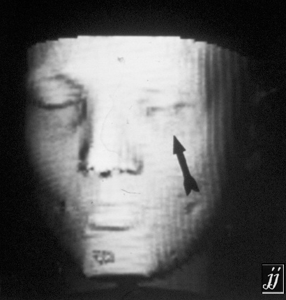 CMF- left orbital eyelid swelling - Radioogle