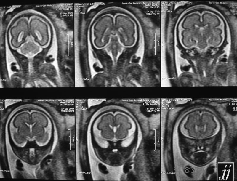 Fetus- fetal brain MRI, normal Anatomy (5) - Radioogle