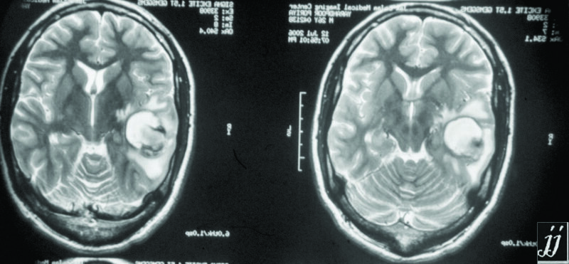 Brain- left parietal hematoma with edema (1) - Radioogle