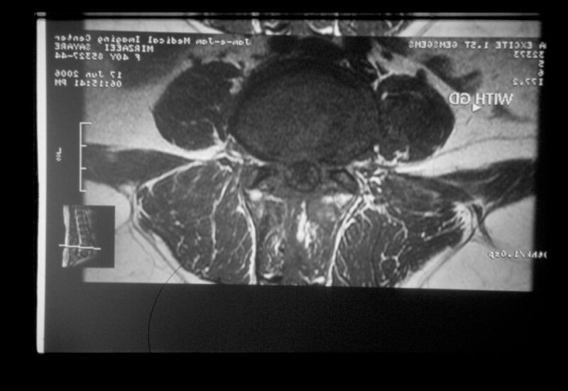 Spine- normal lumbar anatomy - Radioogle