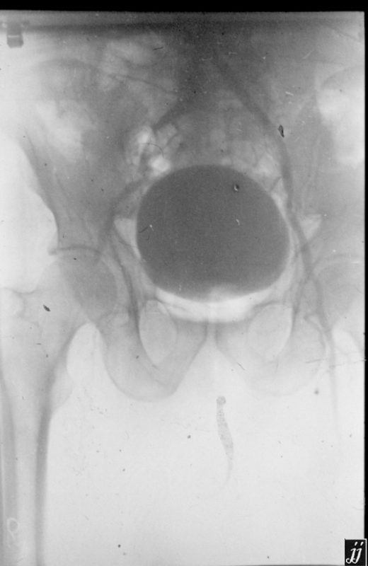 Abdomen- leriche syndrome - Radioogle