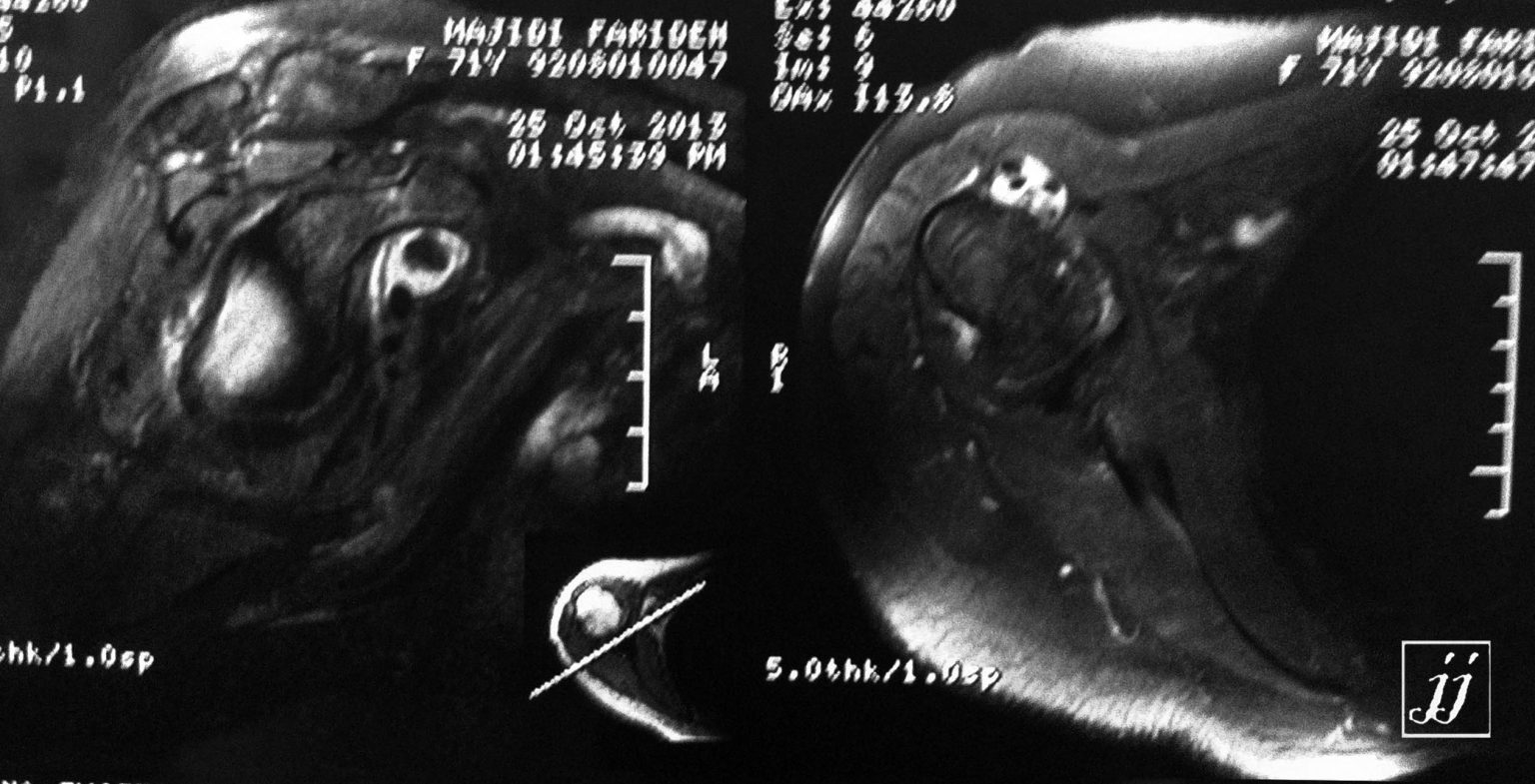 MSK- Deforming osteoarthritis of shoulder joint with effusion with ...