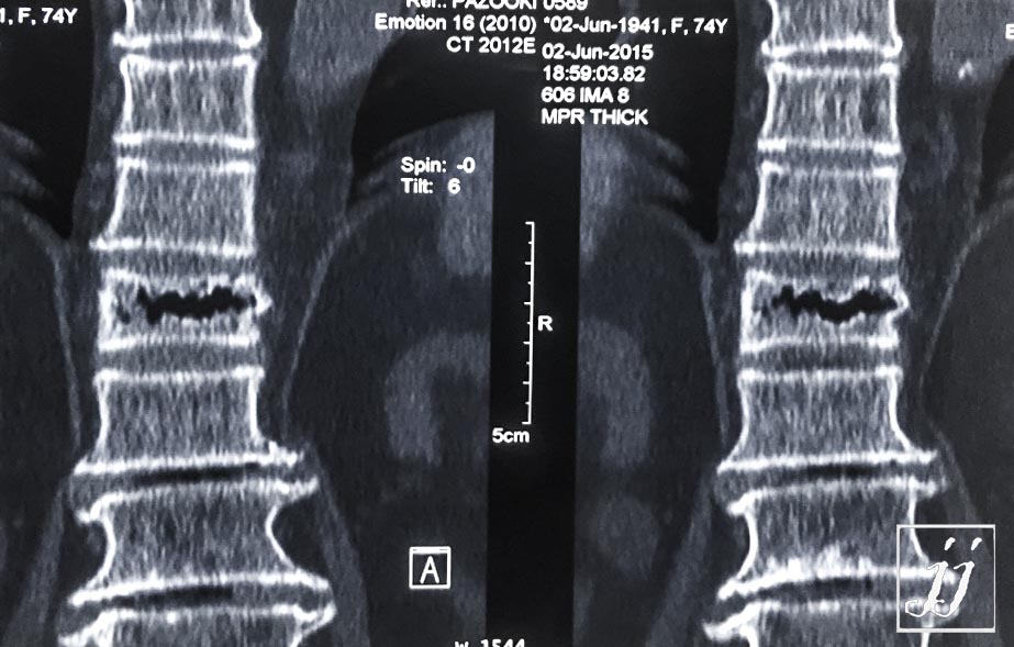 Spine- vertebral body fraction and nitrogen gas degeneration - Radioogle
