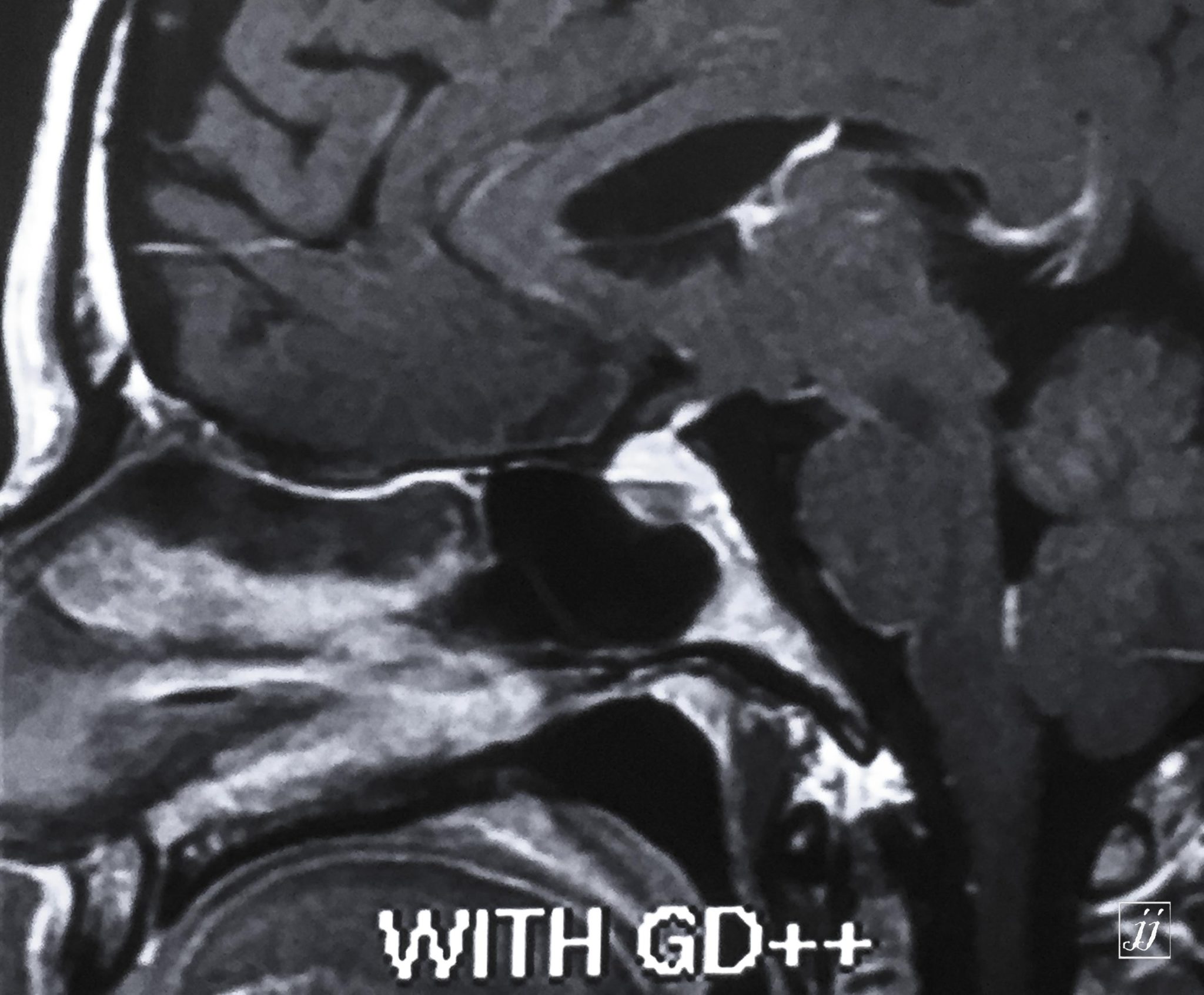 Hyp- Hemorrhage in pituitary gland, Sheehan syndrome (5) - Radioogle
