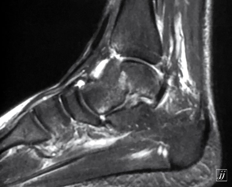 MSK- distal tibial fracture (3) - Radioogle