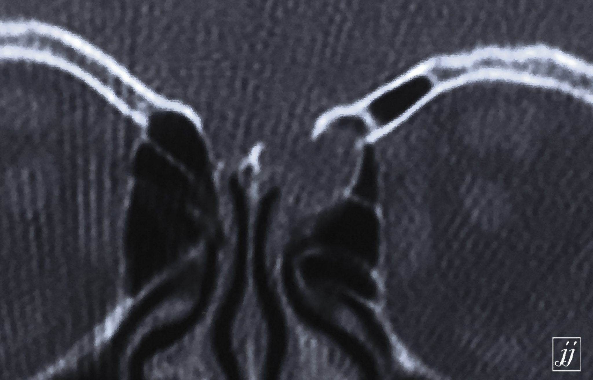 ENT- deep anterior cranial fossa and mucocele in lamina cribrosa (2 ...