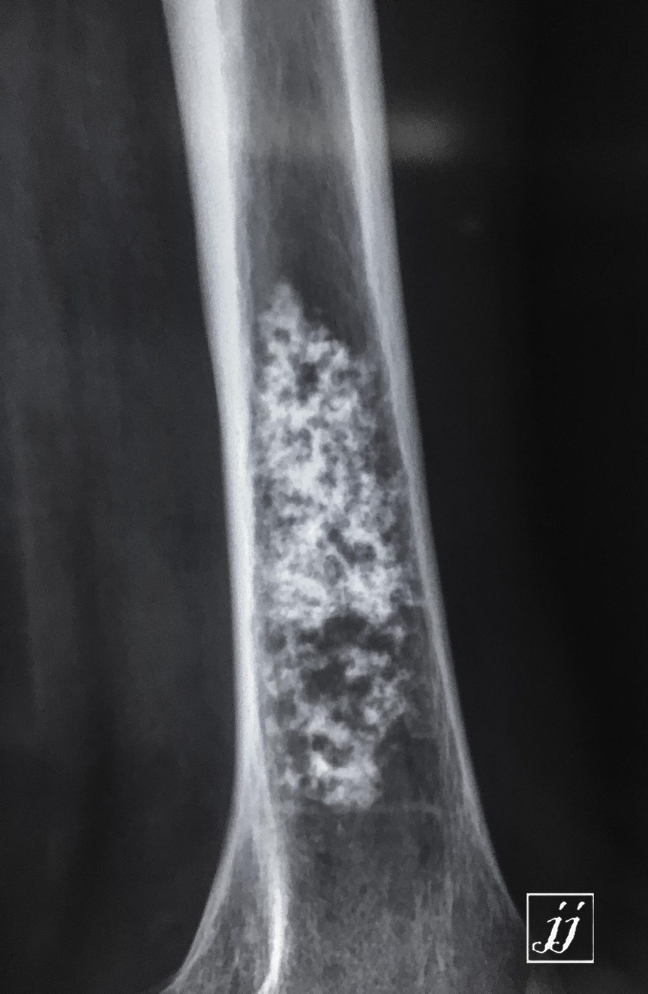 MSK- distal femoral shaft sclerotic lesion with joint osteoarthritic ...
