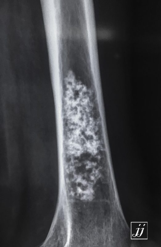 MSK- distal femoral shaft sclerotic lesion with joint osteoarthritic ...