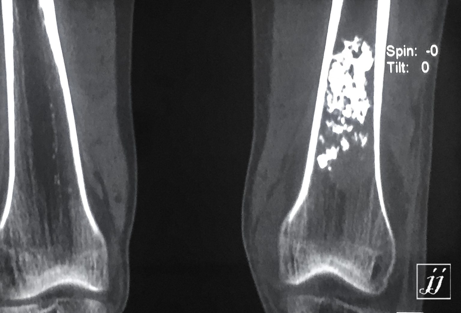 MSK- distal femoral shaft sclerotic lesion with joint osteoarthritic ...