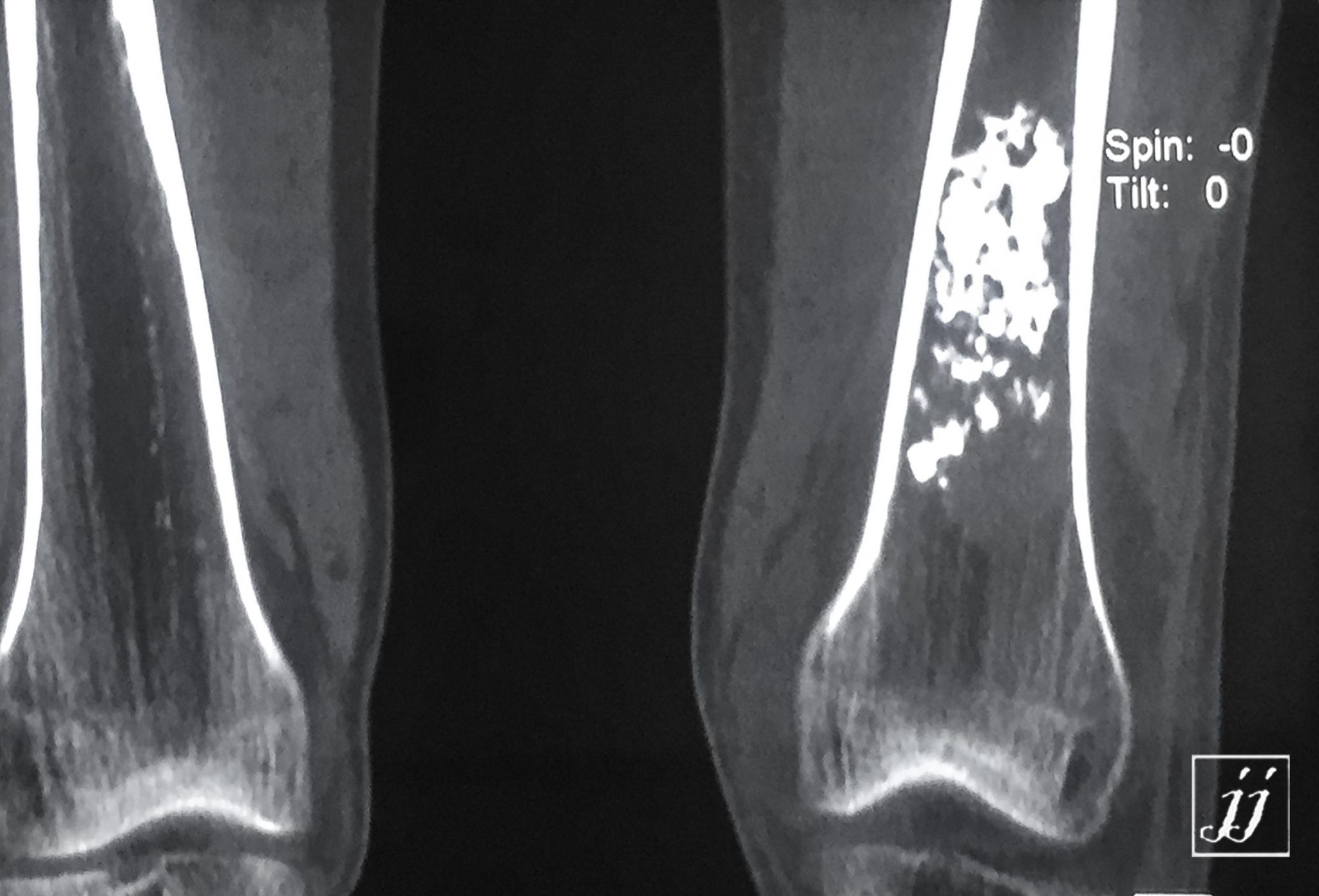 MSK- distal femoral shaft sclerotic lesion with joint osteoarthritic ...