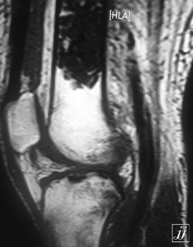 MSK- distal femoral shaft sclerotic lesion with joint osteoarthritic ...