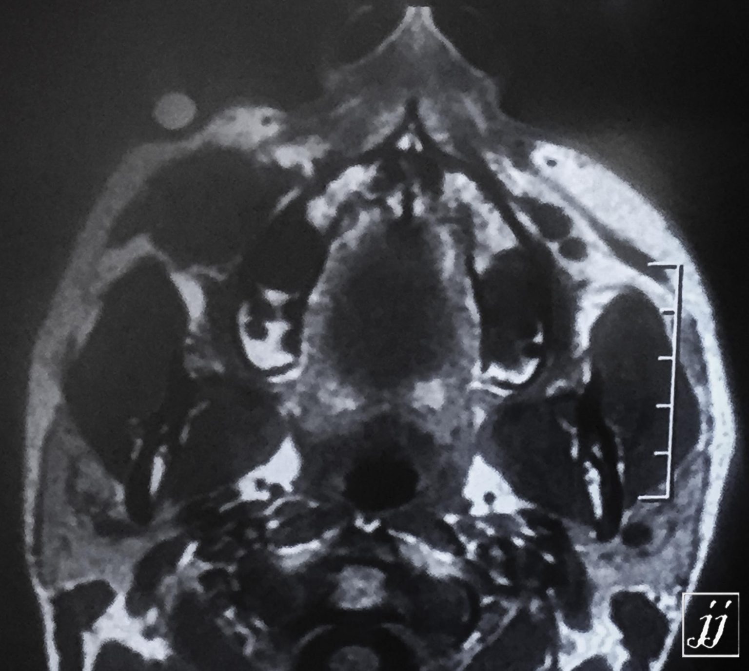 Orbit- right maxillary sinus retention cyst (7) - Radioogle