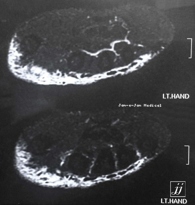 Radioogle | MSK- dorsal hand subcutaneous edema (3)