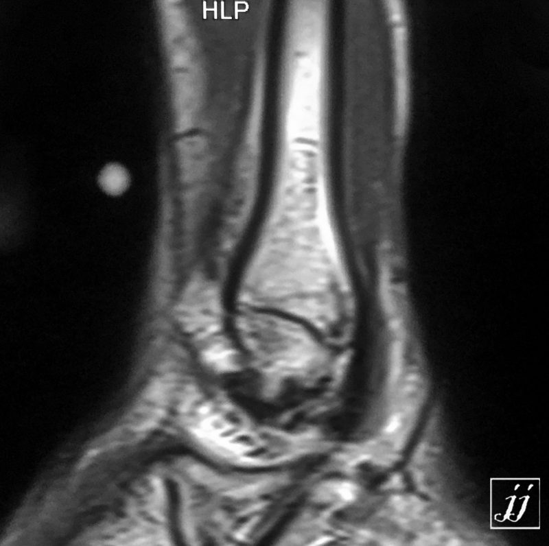 MSK- tibia fibular bone bruising at epiphyseal junction, micro ...