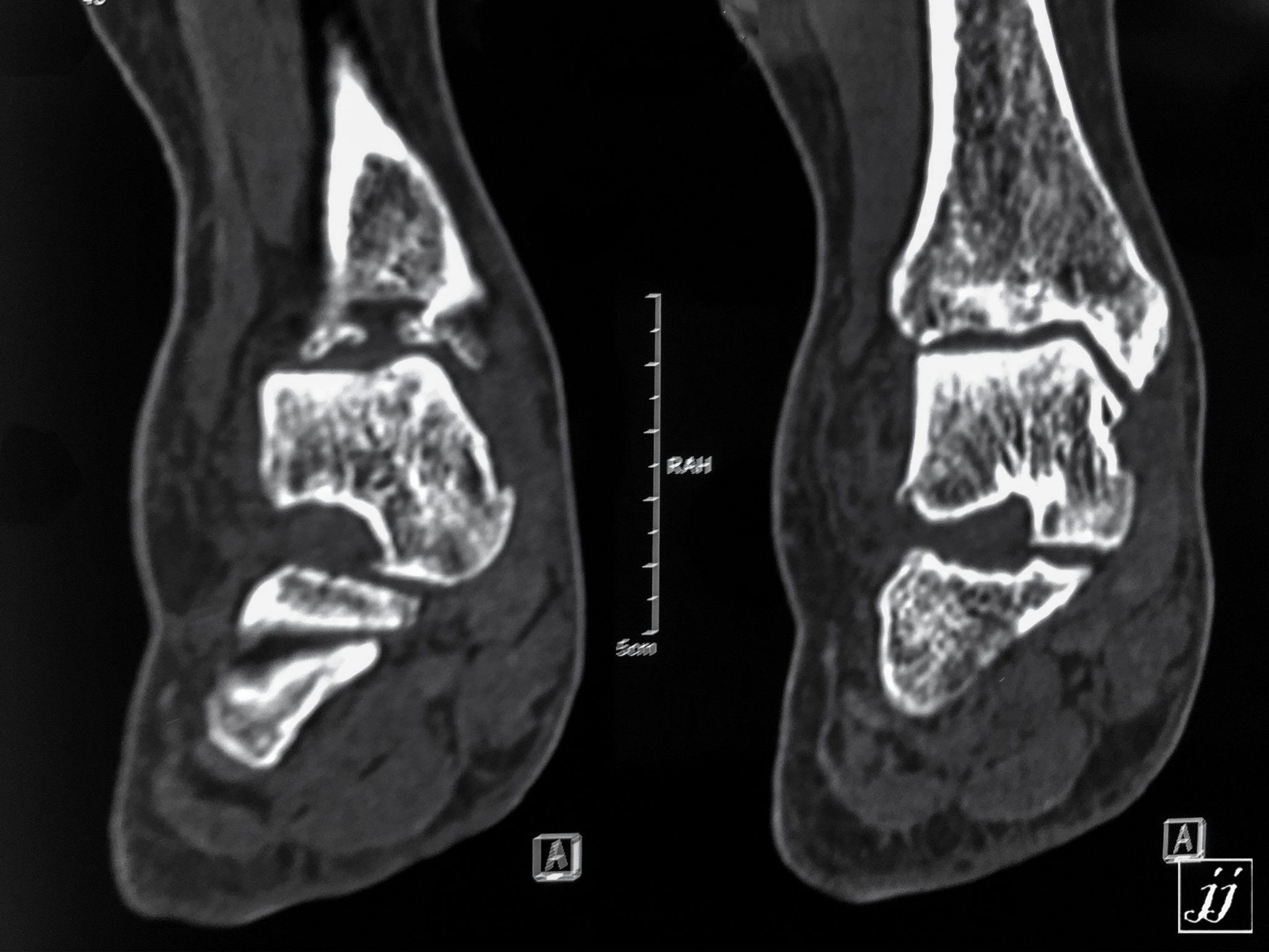 MSK- detached fracture of anterior tibial edge (7) - Radioogle