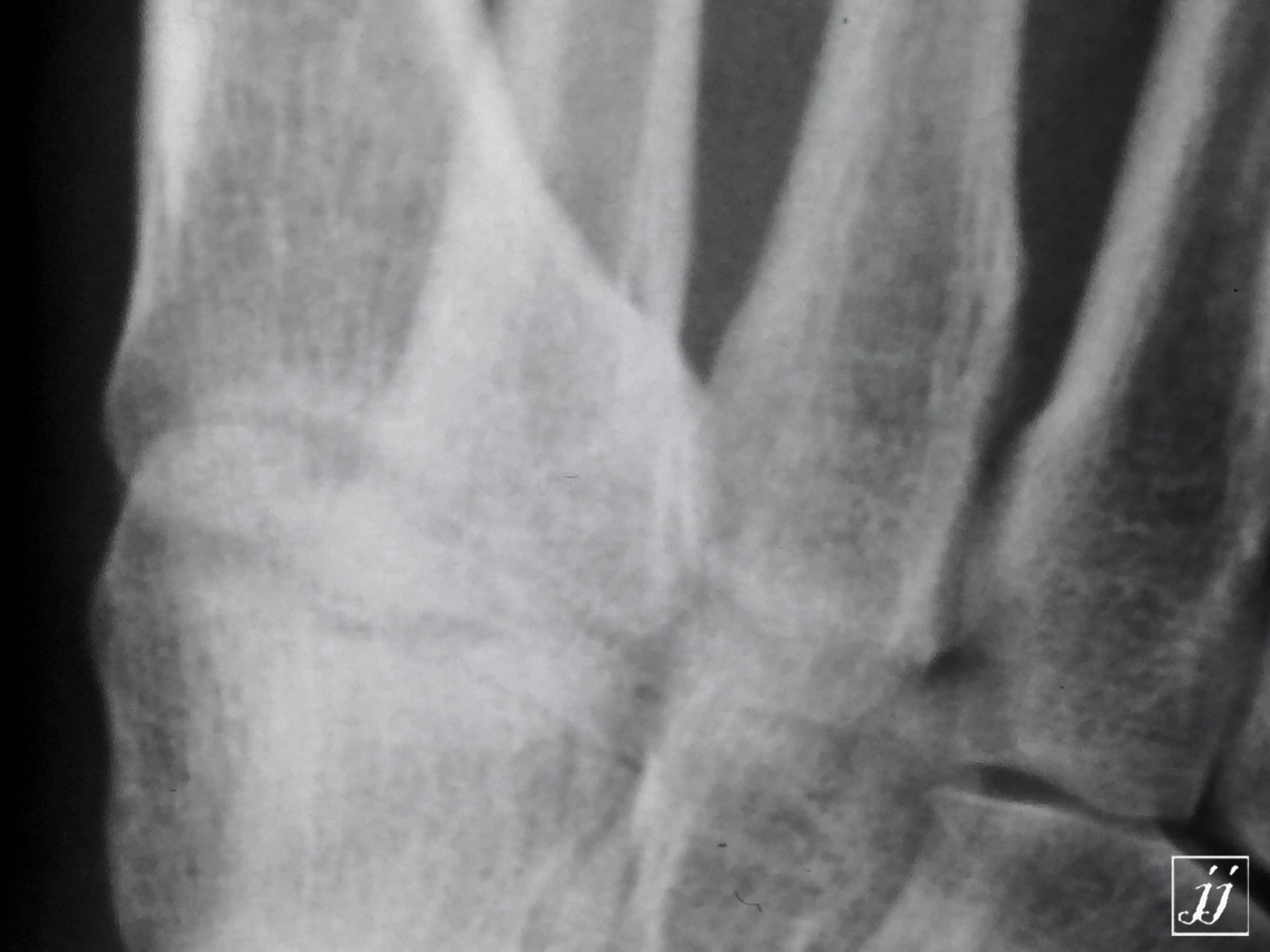 MSK- periosteal reaction of distal third metatarsal bone, fatigue ...