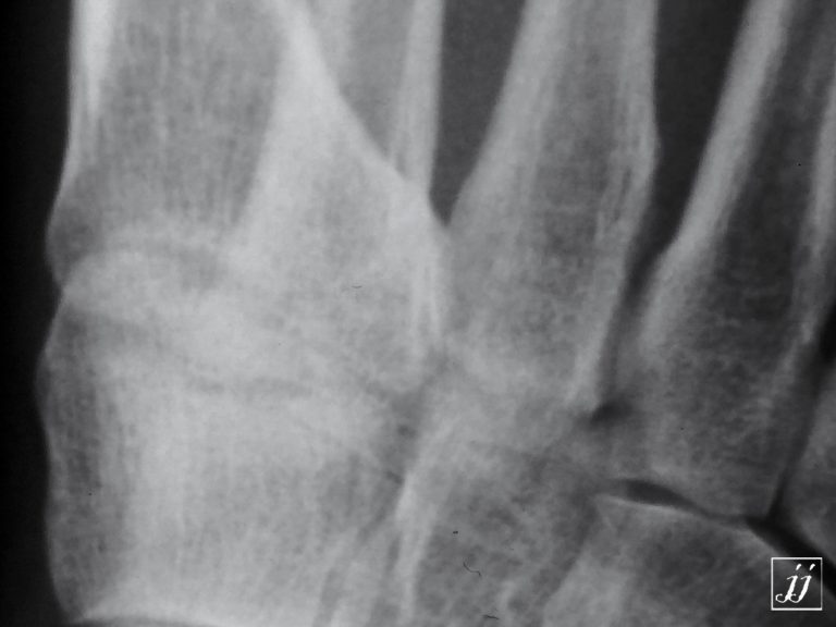 MSK- periosteal reaction of distal third metatarsal bone, fatigue ...