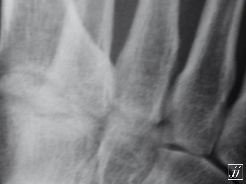 MSK- periosteal reaction of distal third metatarsal bone, fatigue ...