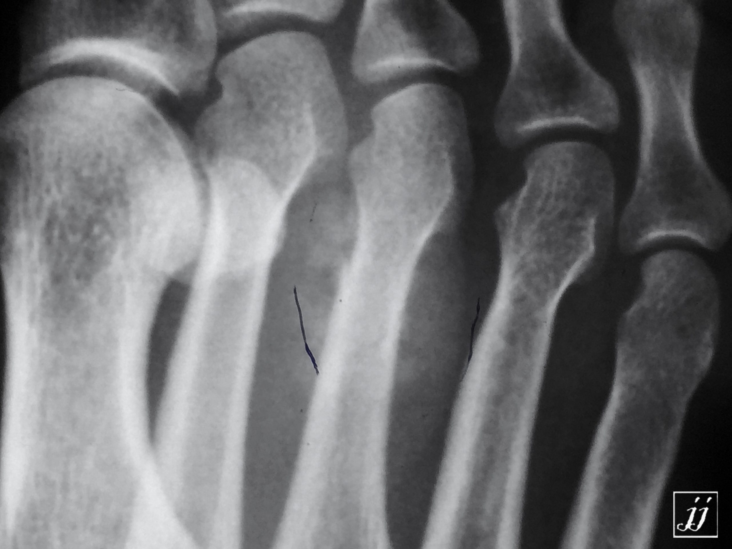 MSK- periosteal reaction of distal third metatarsal bone, fatigue ...
