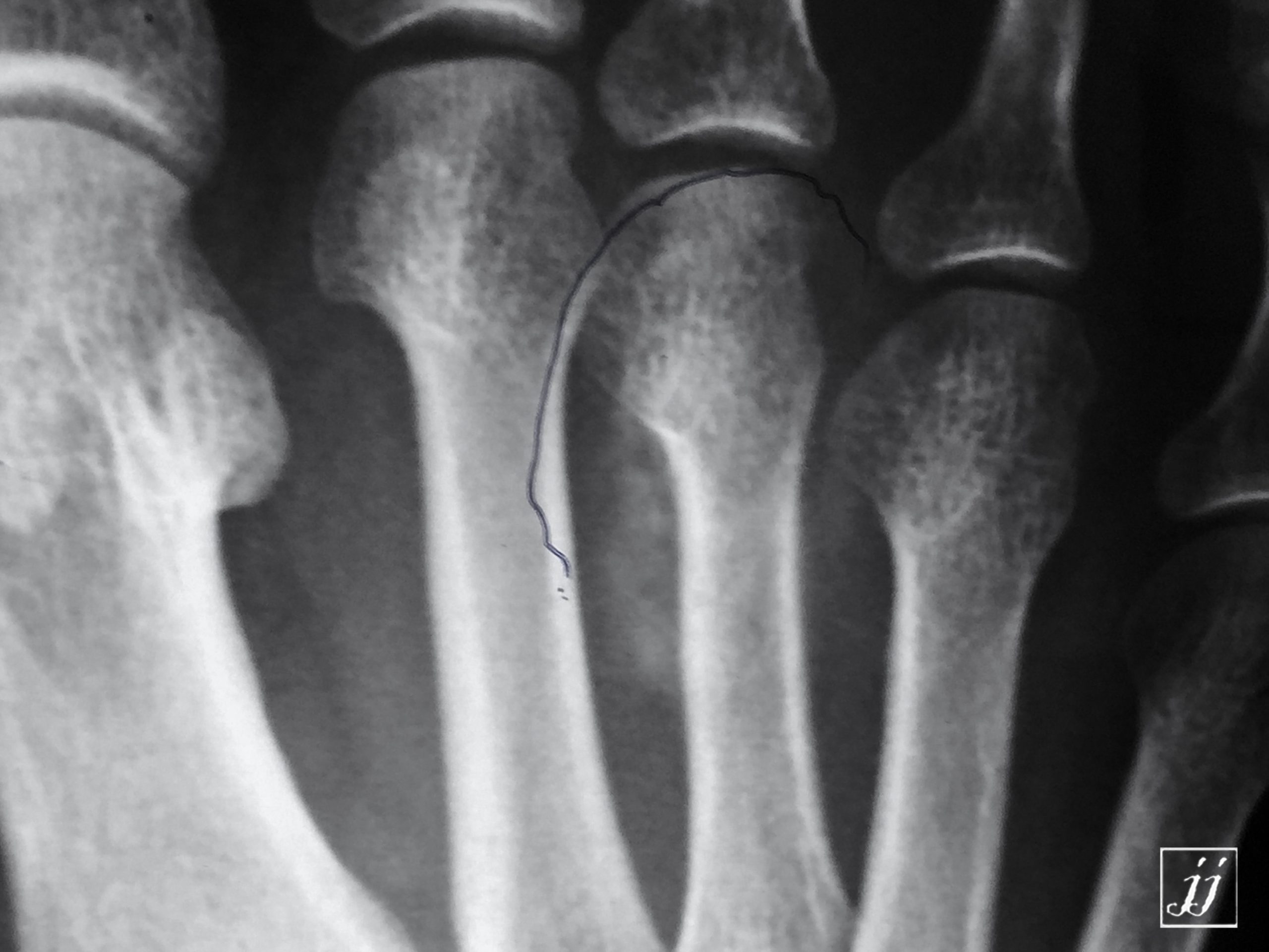 MSK- periosteal reaction of distal third metatarsal bone, fatigue ...