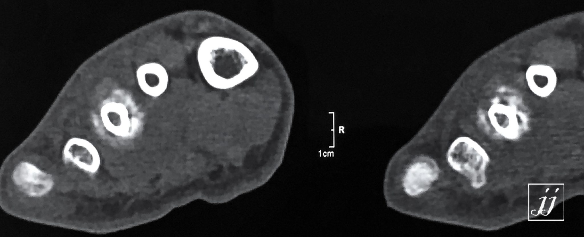 MSK- periosteal reaction of distal third metatarsal bone, fatigue ...