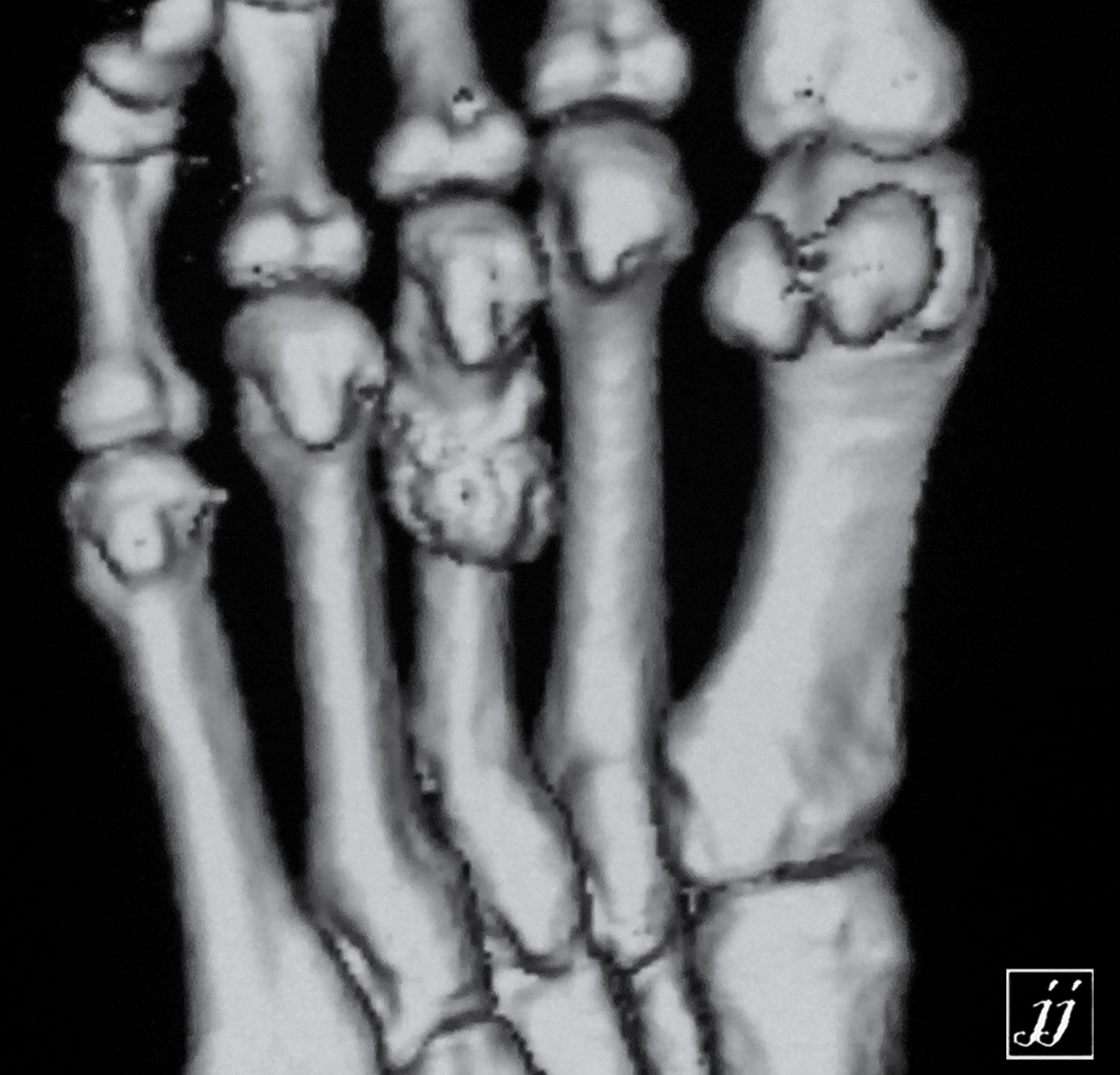 MSK- periosteal reaction of distal third metatarsal bone, fatigue ...