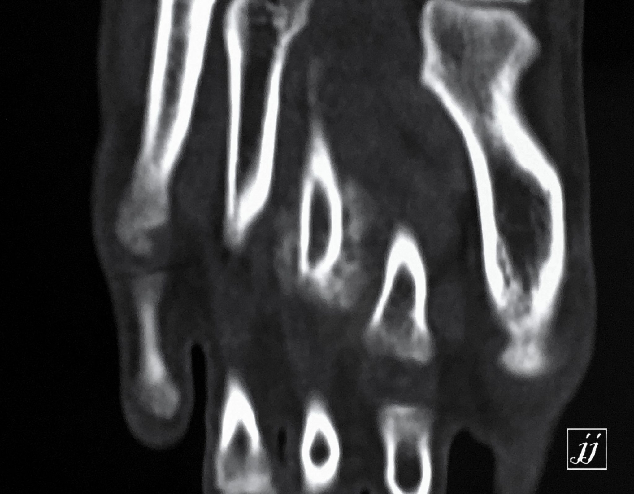 MSK- periosteal reaction of distal third metatarsal bone, fatigue ...