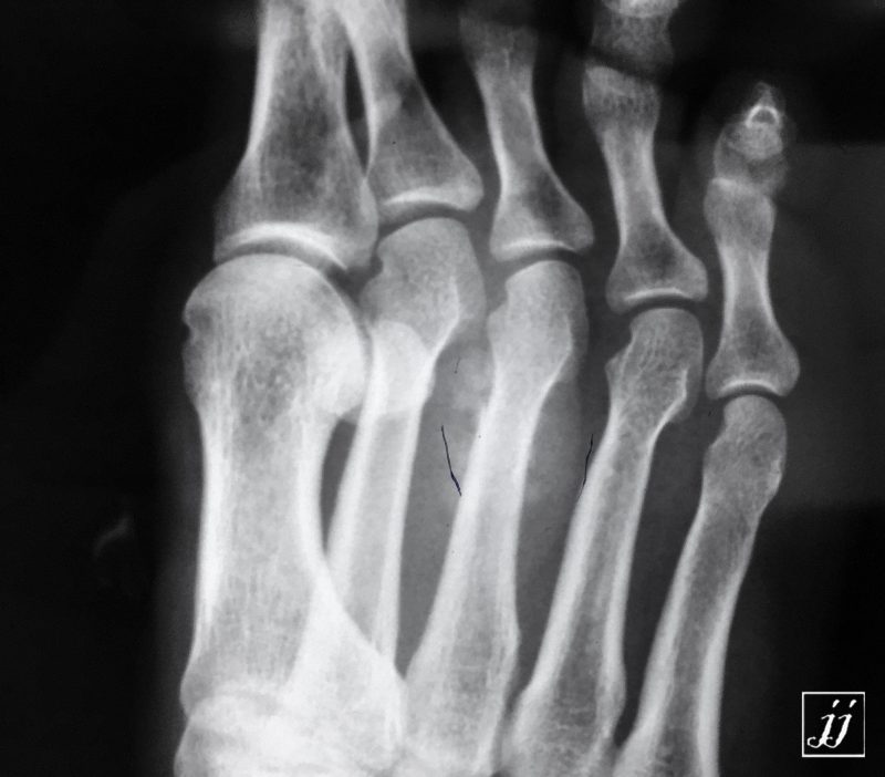 MSK- periosteal reaction of distal third metatarsal bone, fatigue ...