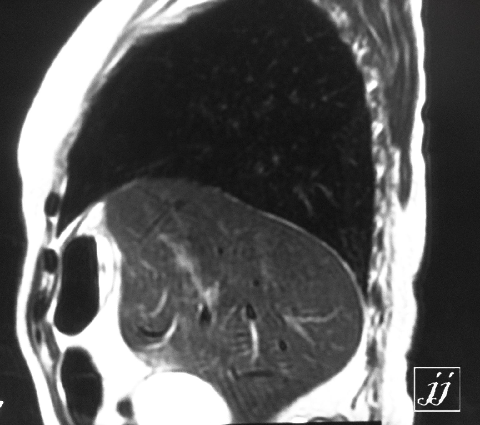 Abdomen- interposition of colon between liver and diaphragm, chilaiditi ...