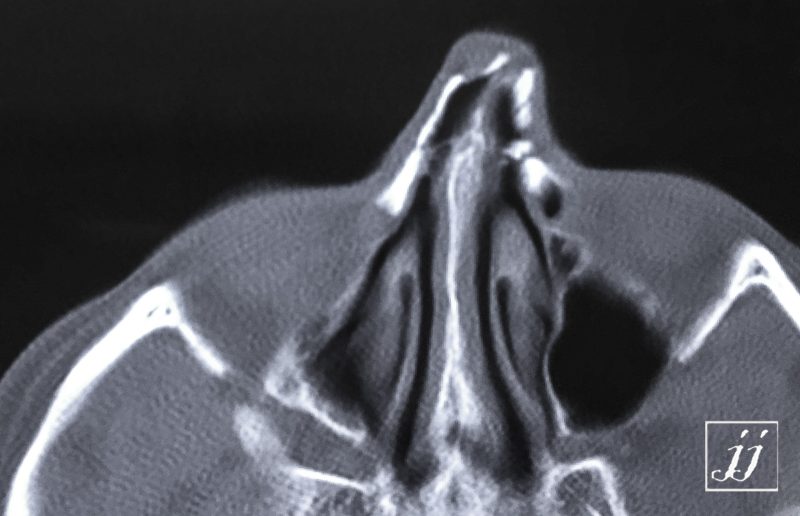 ENT- hyper trophic right inferior turbinate and atrophy of left side ...
