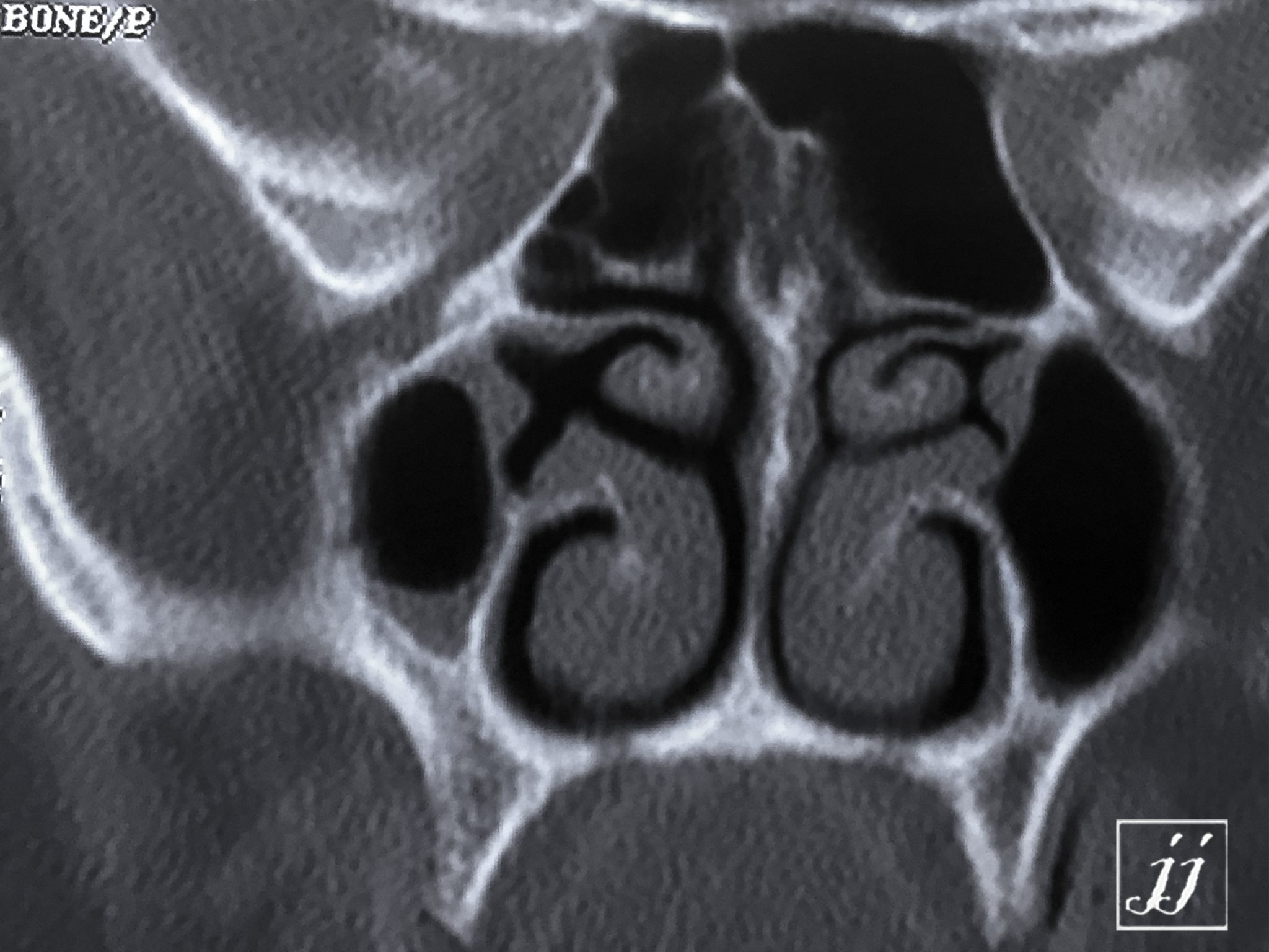 ENT- small left maxillary sinus and nasal bone fractures (4) - Radioogle