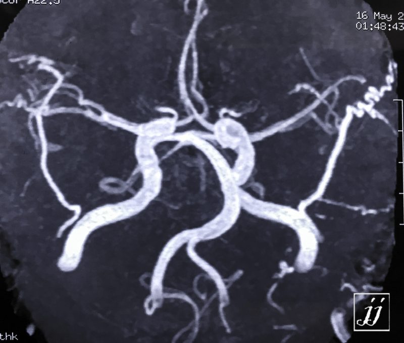 Brain- normal brain MRA with prominent meningeal median artery (2 ...