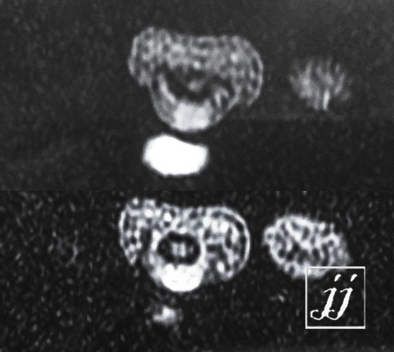 MSK- dorsal finger extensor tendon ganglion cyst (2) - Radioogle