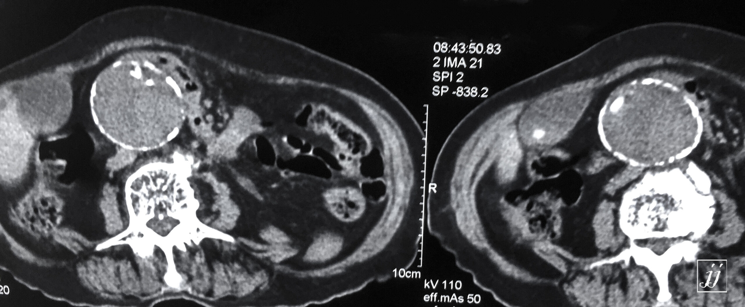 Abdomen- aortic medial sclerosis and aneurism (9) - Radioogle