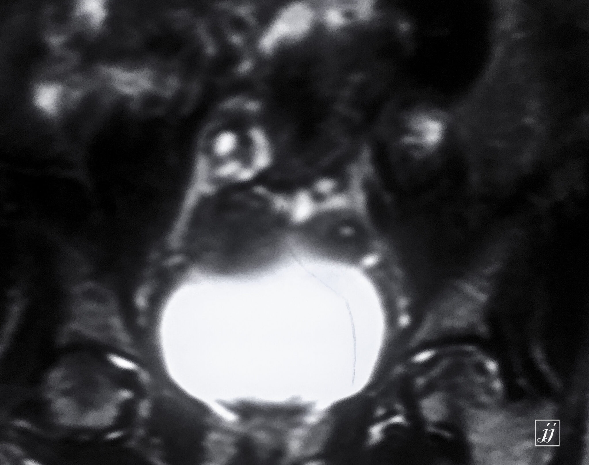 MSK- pelvic floor abscess osteomyelitis and left femoral osteomyelitis ...